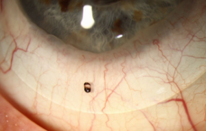 Our Science – EyePrint Prosthetics